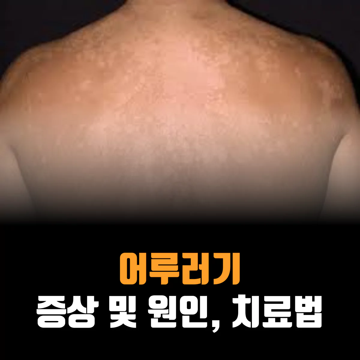 어루러기 증상 및 원인 치료 방법 Ft 백선증 바로팁스